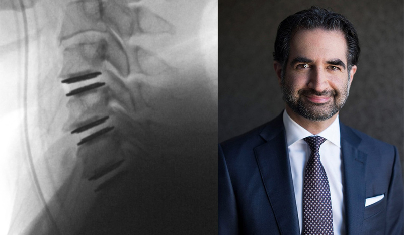 Cervical artificial disc replacement performed